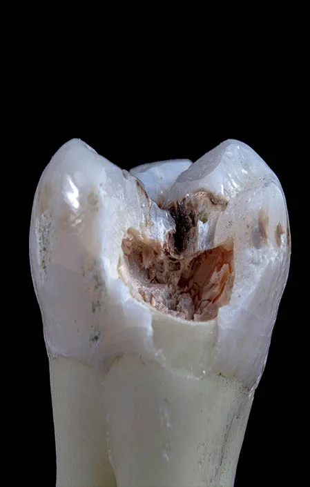 Tooth Decay | Common Problems | Cranbourne North Dental