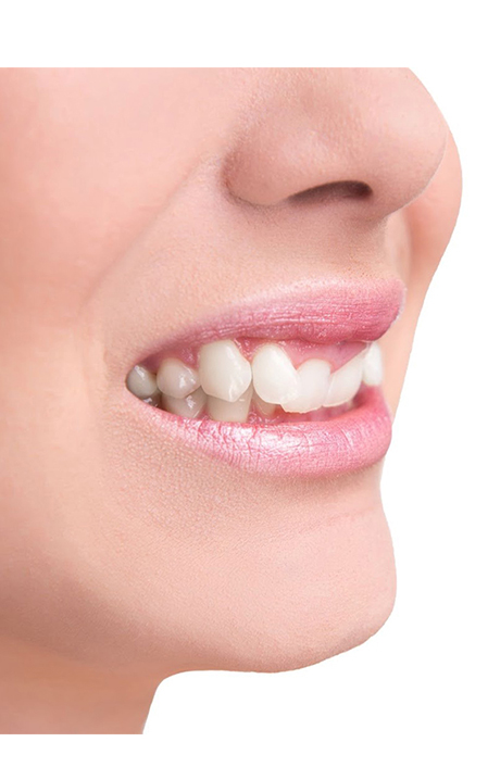 Overbite | Common Problems | Cranbourne North Dental